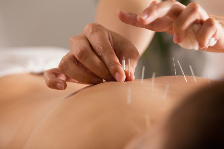 Acupuncture & Cupping | Nexte Integrated Healthcare
